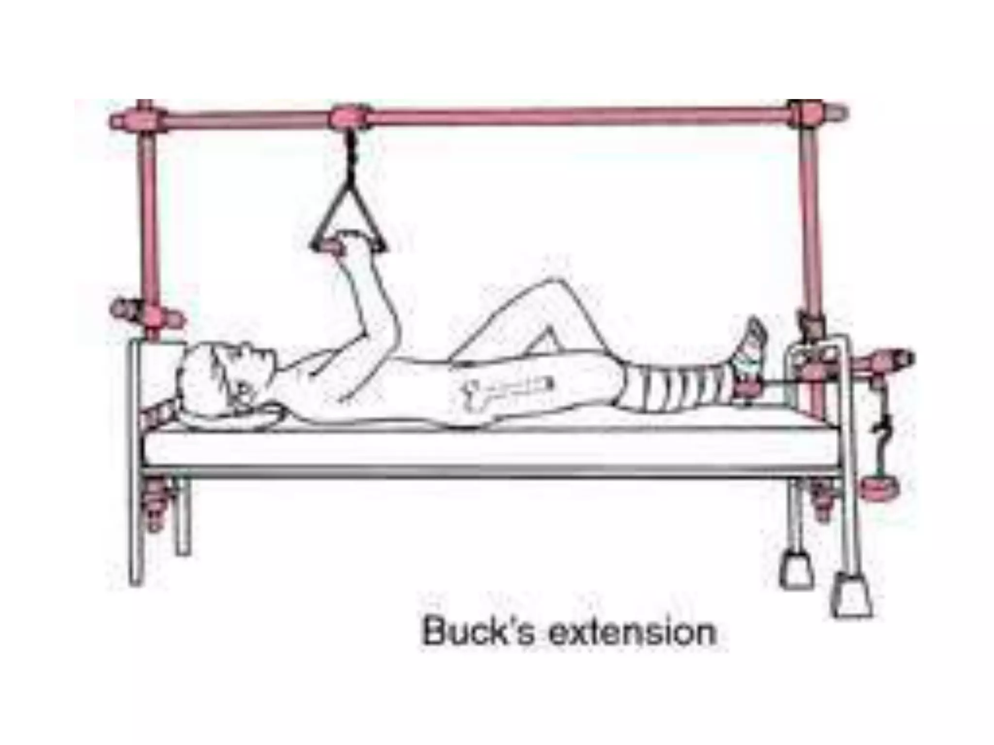 SPLINTS AND TRACTIONS IN ORTHOPAEDICS BY DR ATUL.pptx