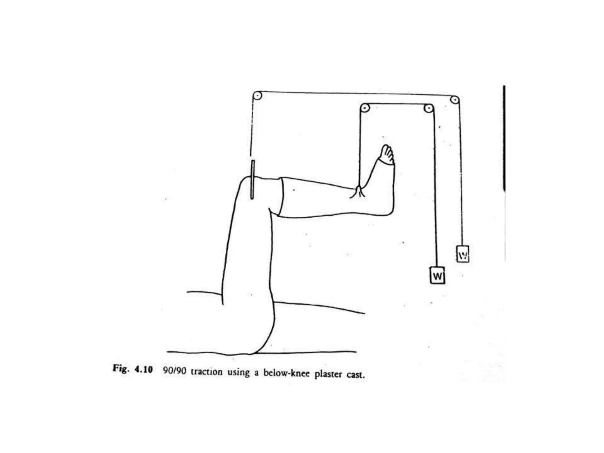SPLINTS AND TRACTIONS IN ORTHOPAEDICS BY DR ATUL.pptx