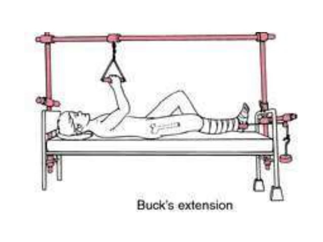 SPLINTS AND TRACTIONS IN ORTHOPAEDICS BY DR ATUL.pptx