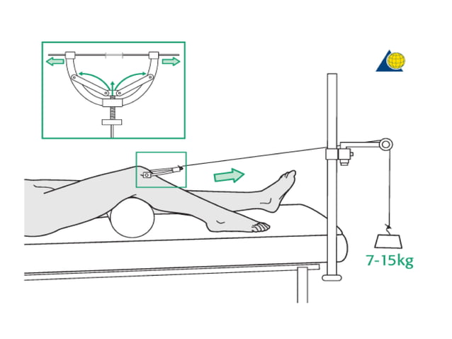 SPLINTS AND TRACTIONS IN ORTHOPAEDICS BY DR ATUL.pptx