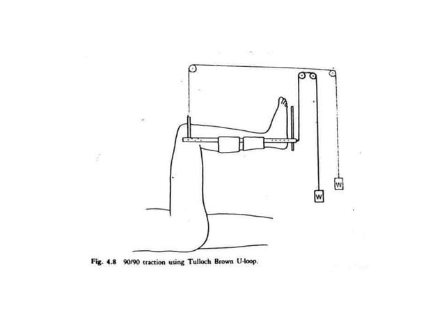 SPLINTS AND TRACTIONS IN ORTHOPAEDICS BY DR ATUL.pptx