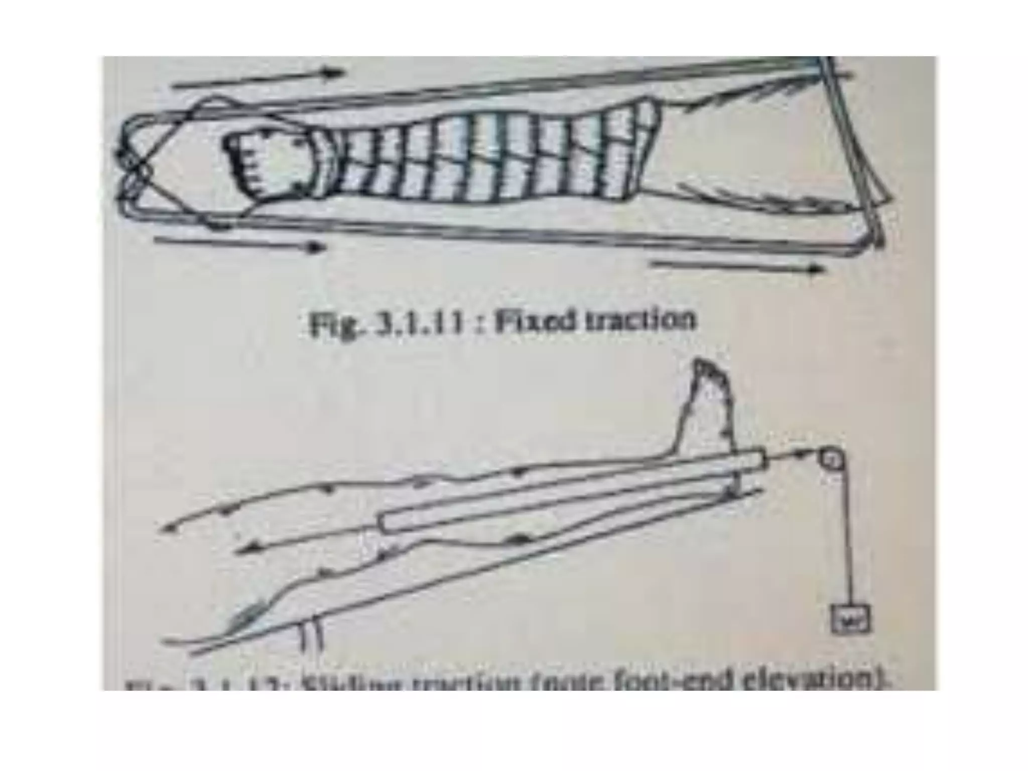 Splints and tractions in orthopedics | PPTX