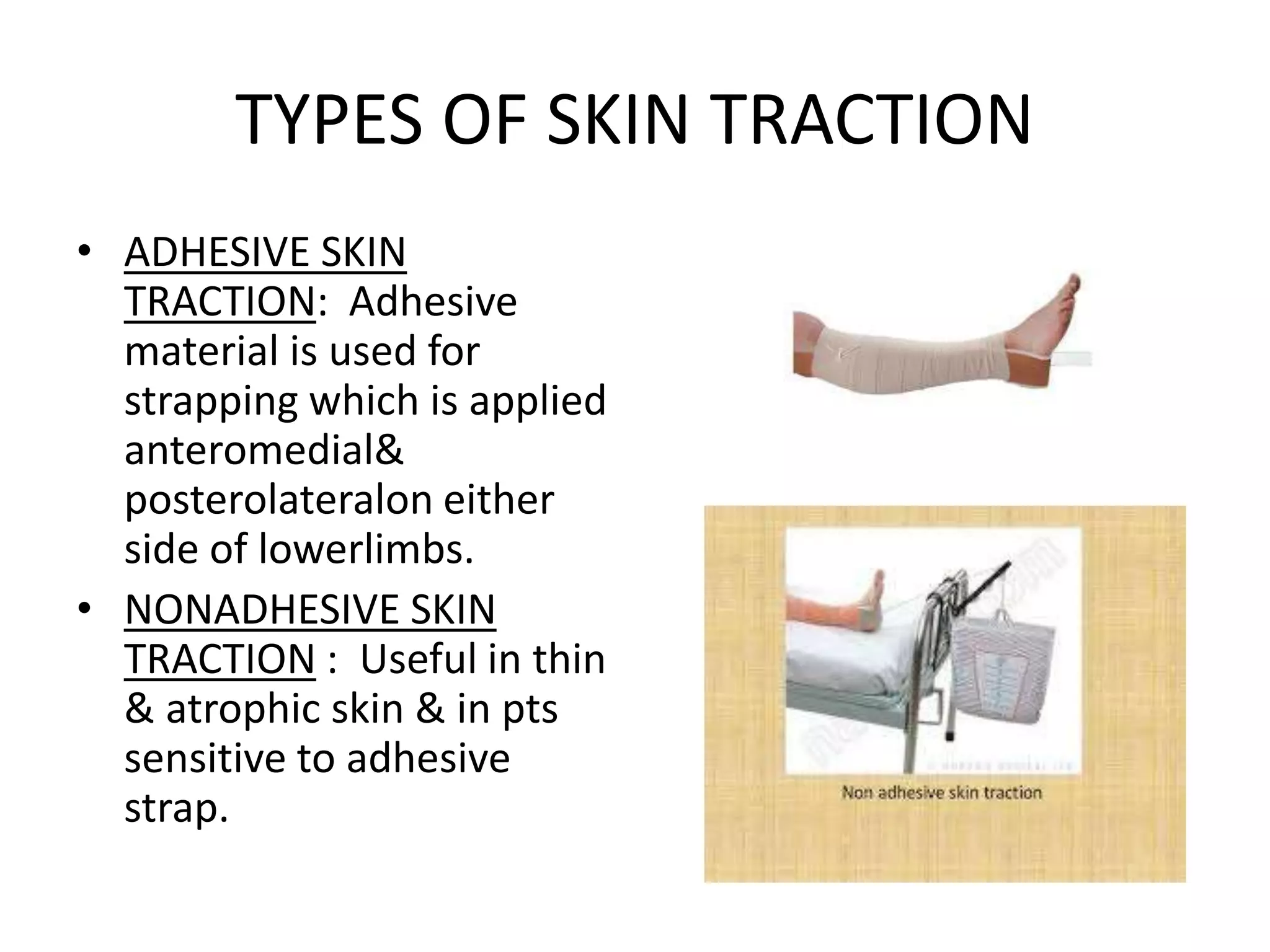 Splints and tractions in orthopedics | PPTX