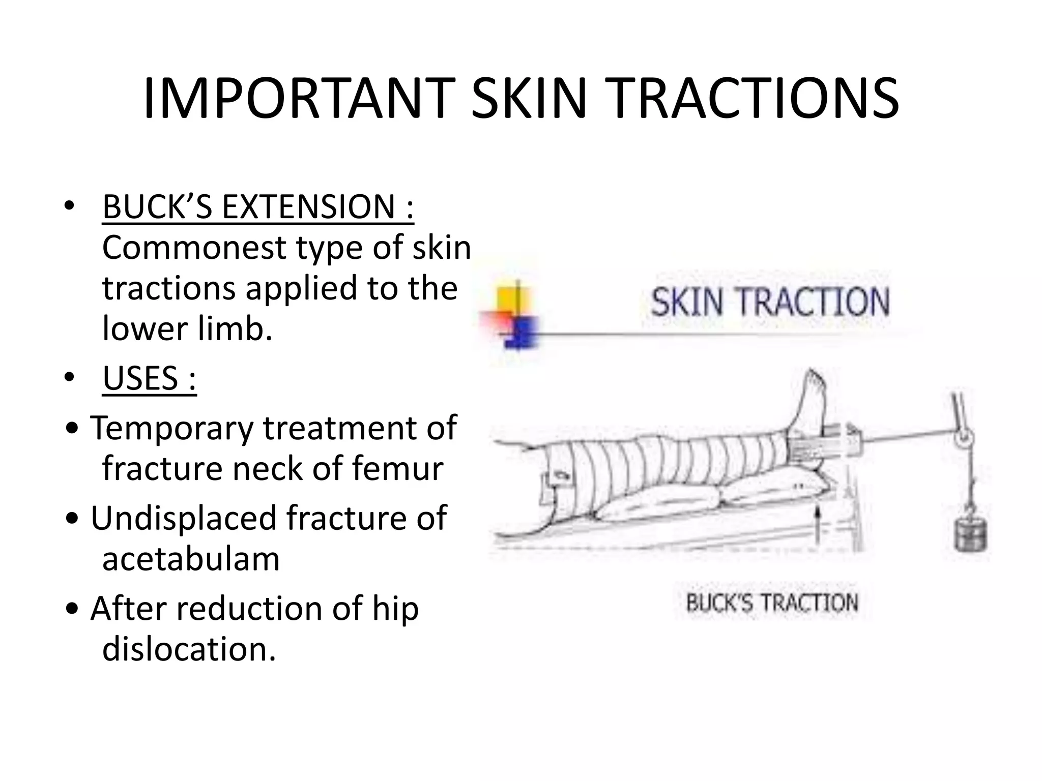 Splints and tractions in orthopedics | PPTX