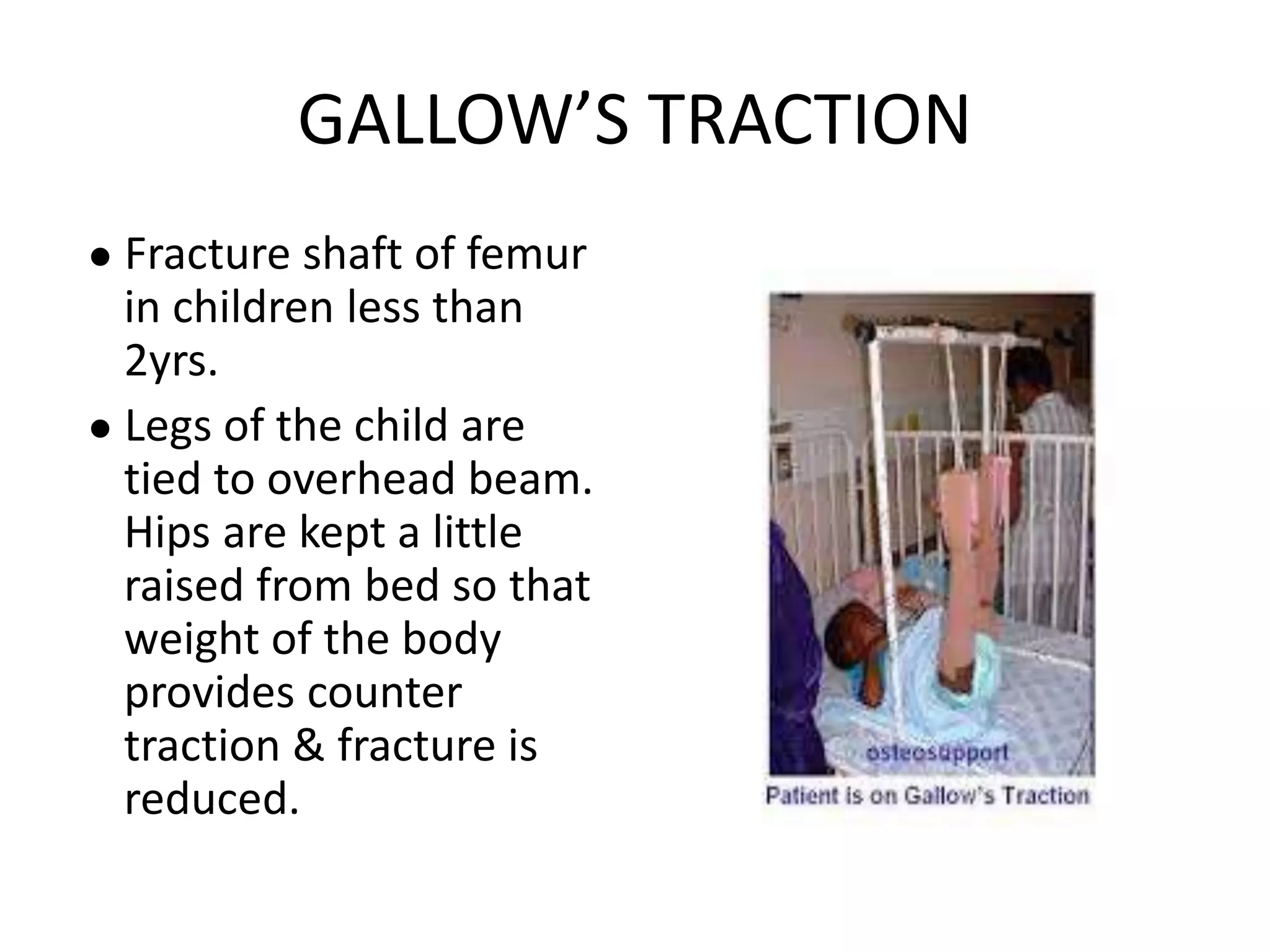 Splints and tractions in orthopedics | PPTX