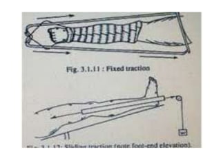 Splints and tractions in orthopedics | PPTX