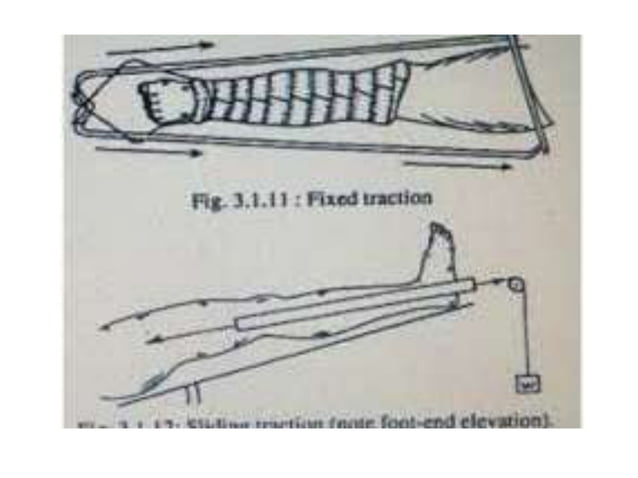 Splints and tractions in orthopedics | PPTX | First Aid | Injuries