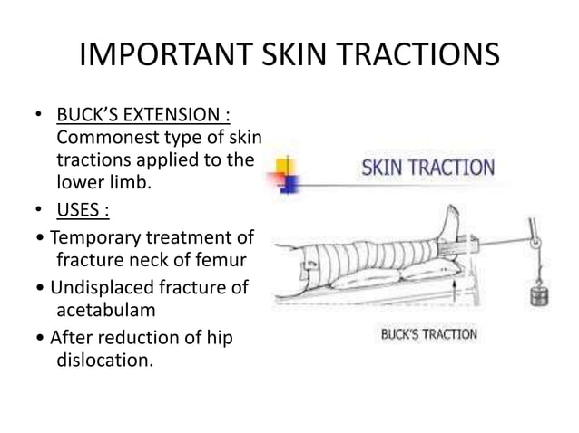 Splints and tractions in orthopedics | PPTX | First Aid | Injuries