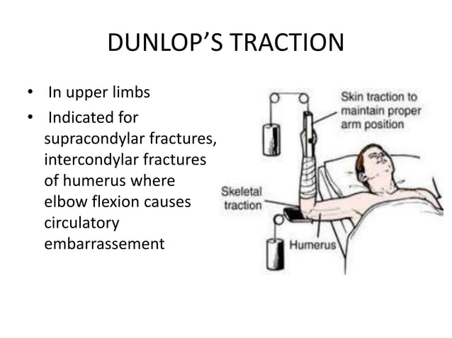 Splints and tractions in orthopedics | PPTX | First Aid | Injuries