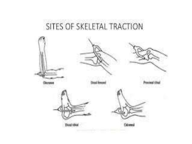 Splints and tractions in orthopedics | PPTX | First Aid | Injuries