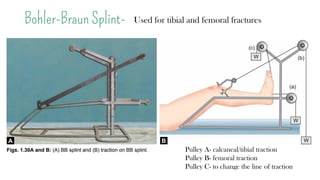 SPLINTS AND TRACTIONS IN ORTHOPEDIC PRACTICE | PDF
