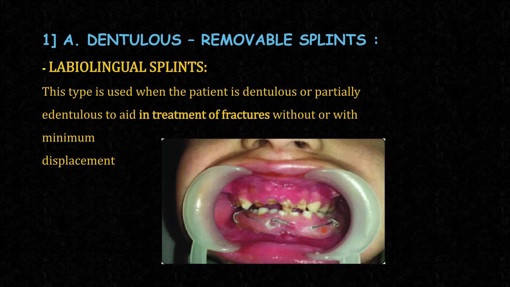 splints .pptx