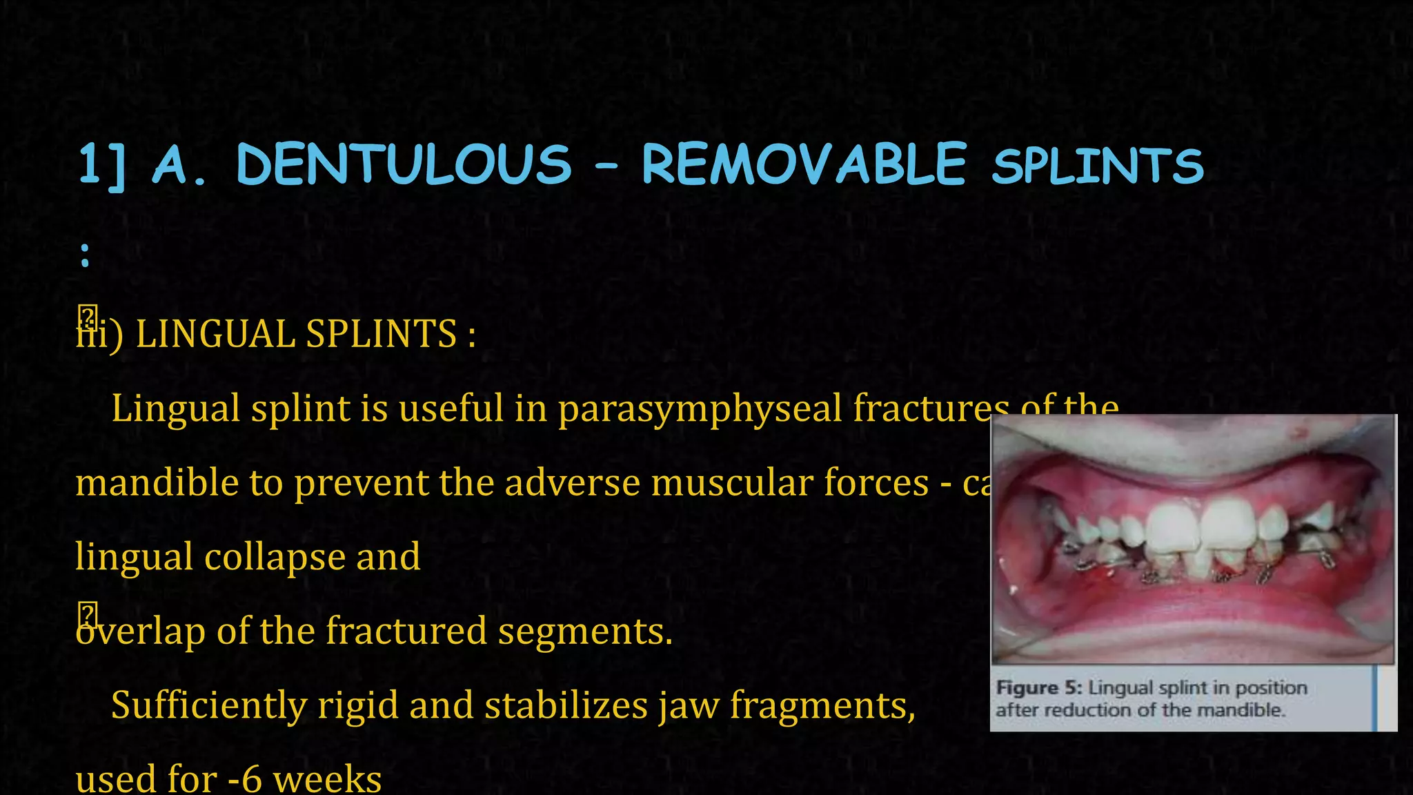 splints .pptx