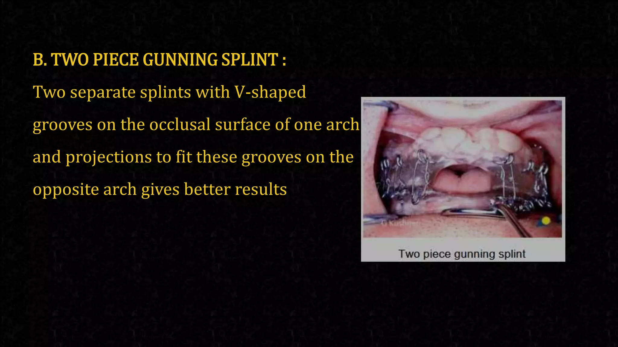 splints .pptx