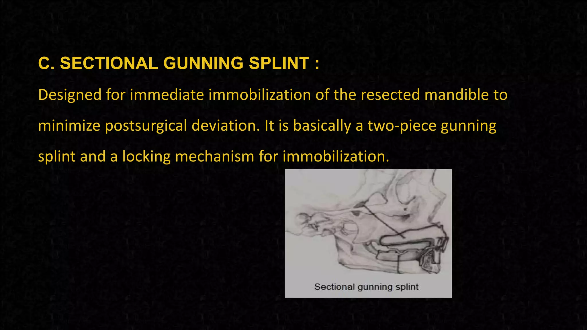 splints .pptx