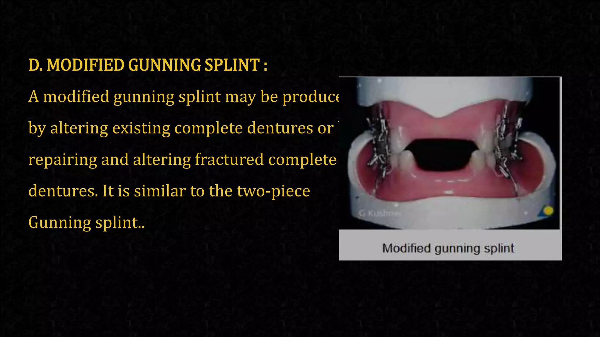 splints .pptx