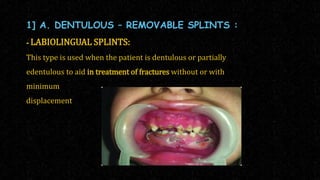 splints .pptx