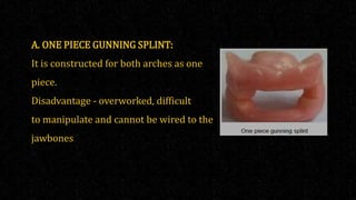 splints .pptx