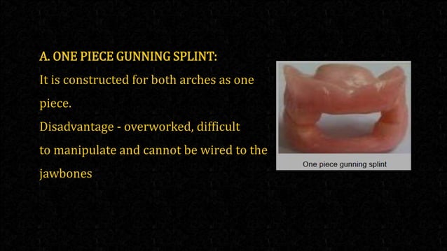 splints .pptx