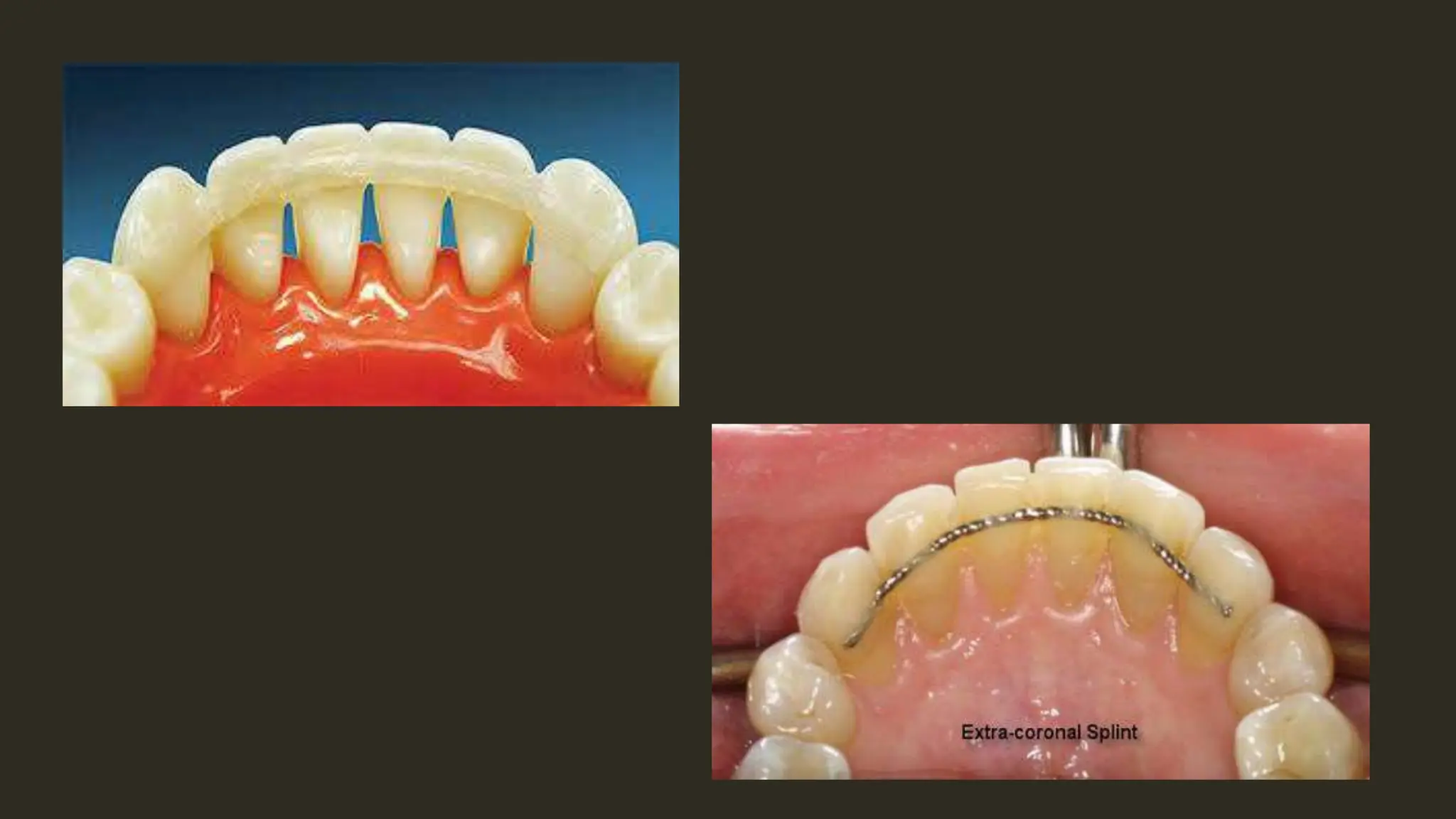 Splints in periodontal therapy - dentistry.pptx