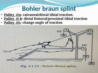splints & tractions IN ORTHOAPAEDIC PRACTICE .pptx