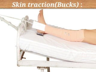 splints & tractions IN ORTHOAPAEDIC PRACTICE .pptx