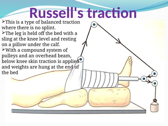 splints & tractions IN ORTHOAPAEDIC PRACTICE .pptx