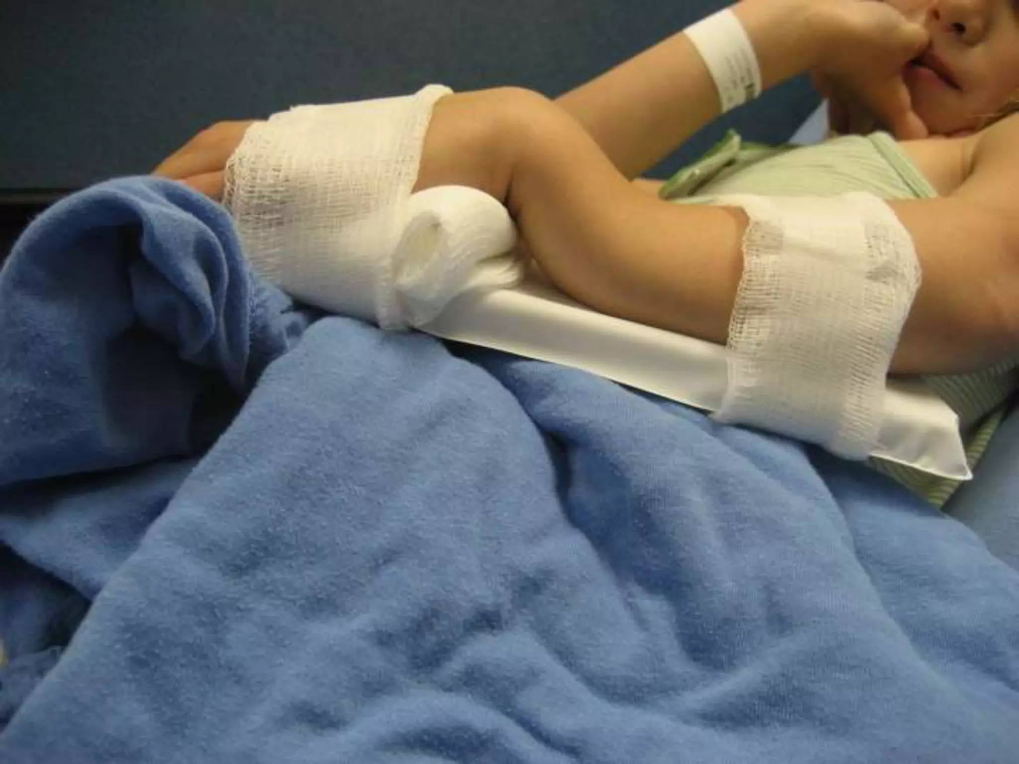 splint the children.ppt