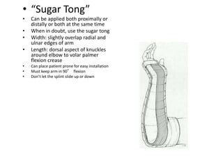 splint the children.ppt