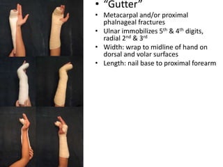 splint the children.ppt