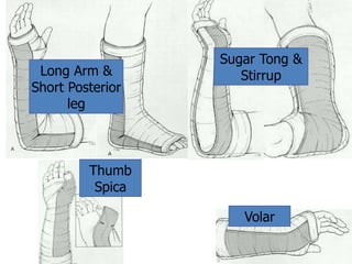 splint the children.ppt