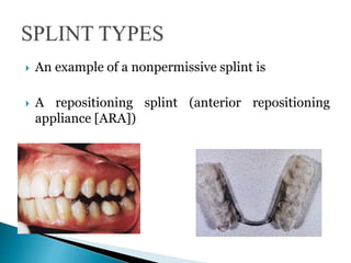 Splint therapy for tmj disc displacement | PPTX