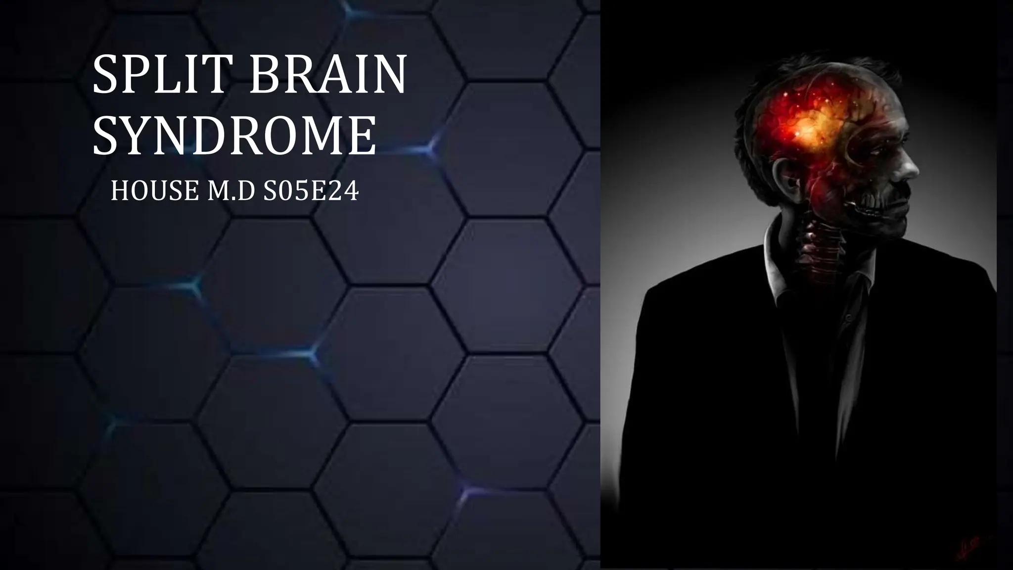 split brain Syndrome .pptx