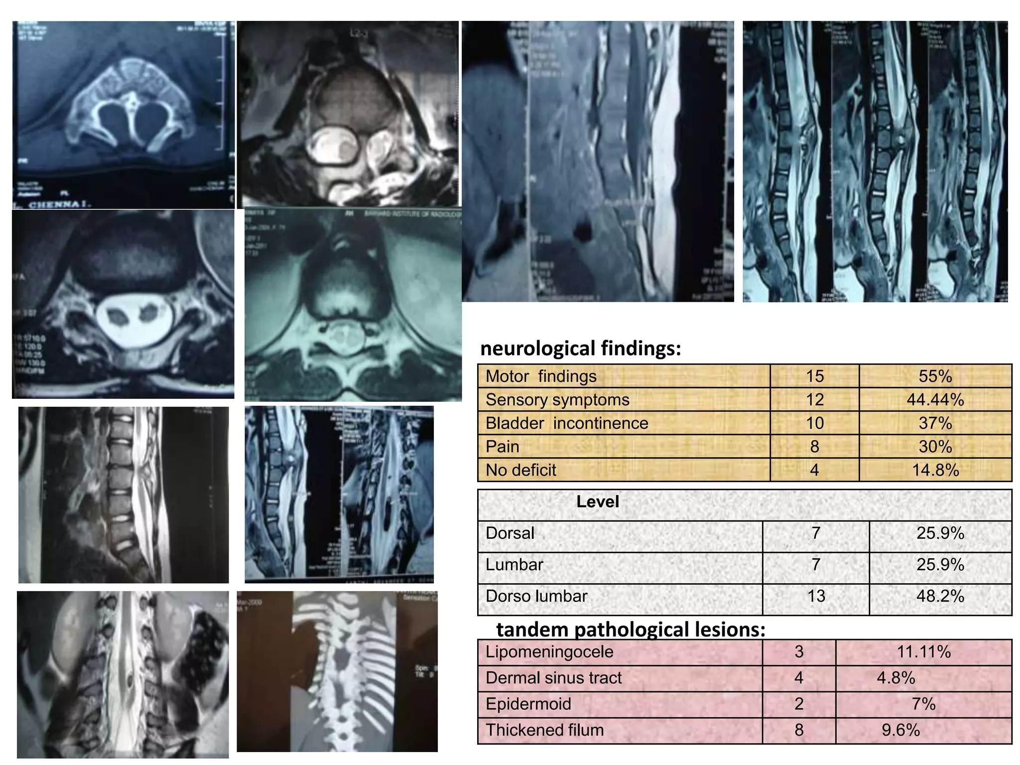Split cord malformation | PPTX