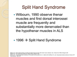 Split Hand Syndrome in Amyotrophic Lateral Sclerosis | PPTX