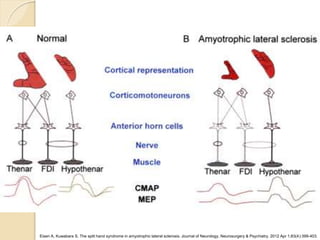 Split Hand Syndrome in Amyotrophic Lateral Sclerosis | PPTX