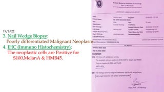 Case of Right Ungal Malignant Melanoma | PPTX