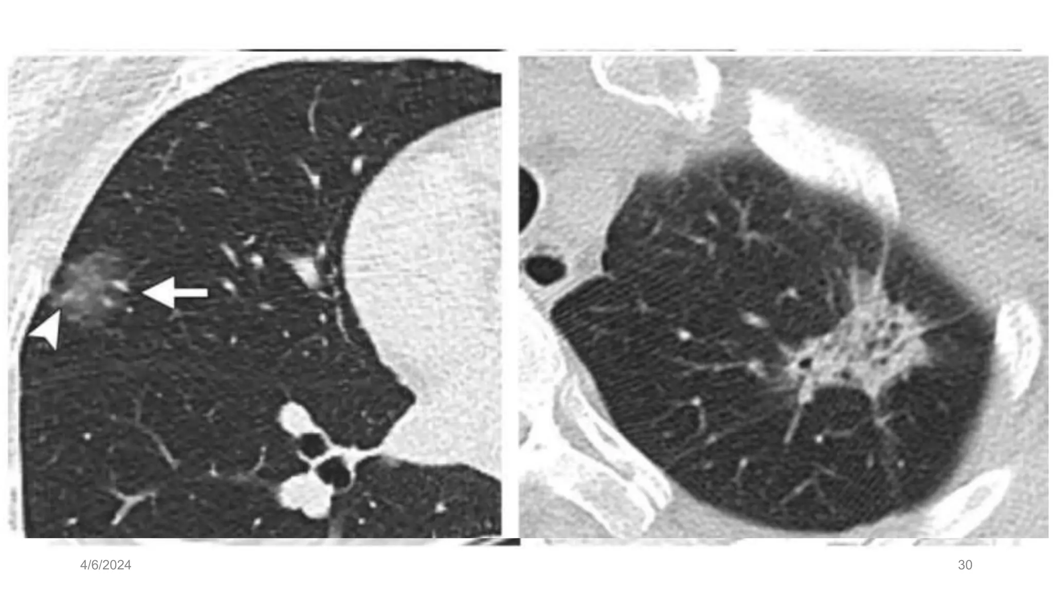 SPN-Imaging of Solitary Pulmonary Nodules.pptx