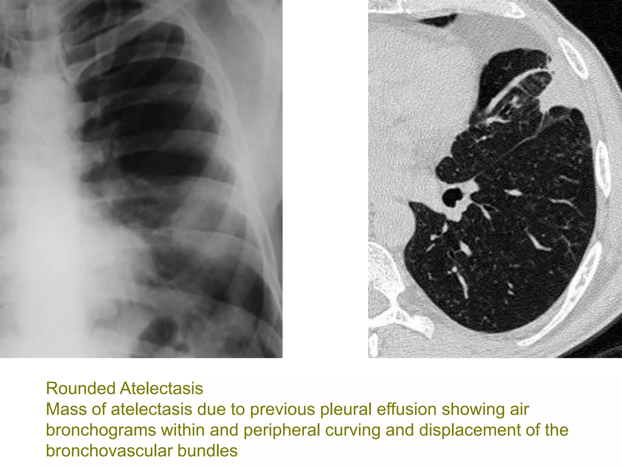 Solitary Pulmonary Nodule | PPTX