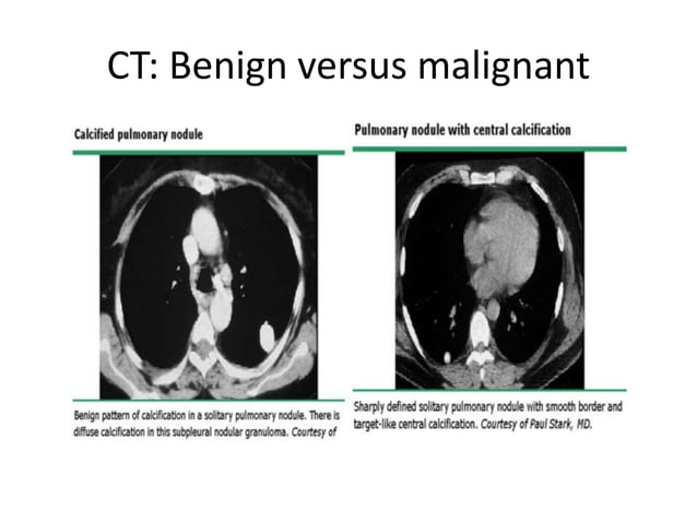 Solitary pulmonary nodule vp.pptx