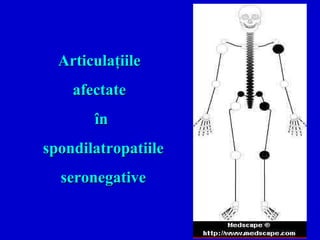 Spondilita anchilozanta | PPT