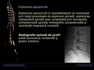 Spondiloliza 29 06 14 | PPTX