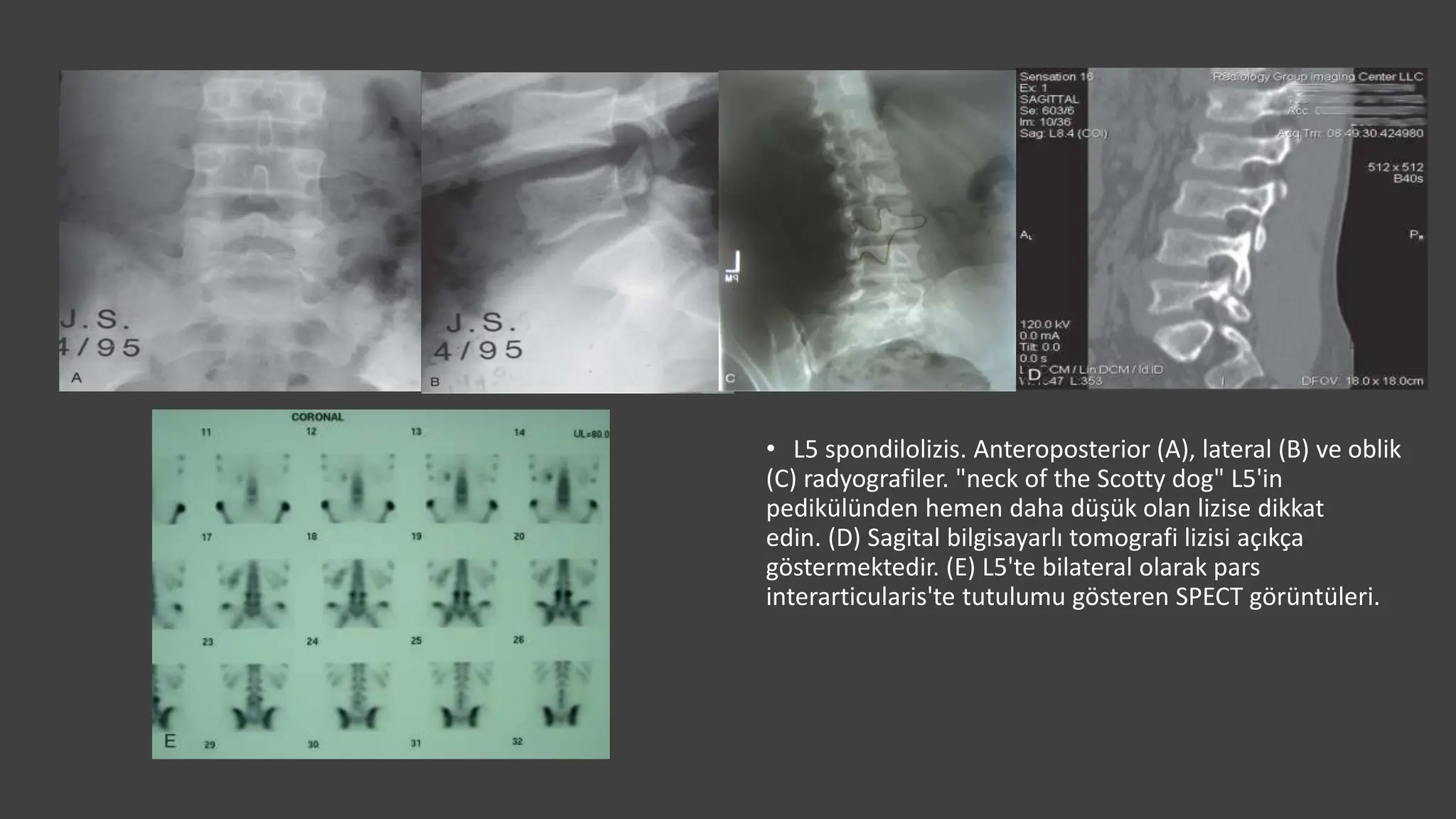 spondiloliztezis ve spondilolizis-2.pptx