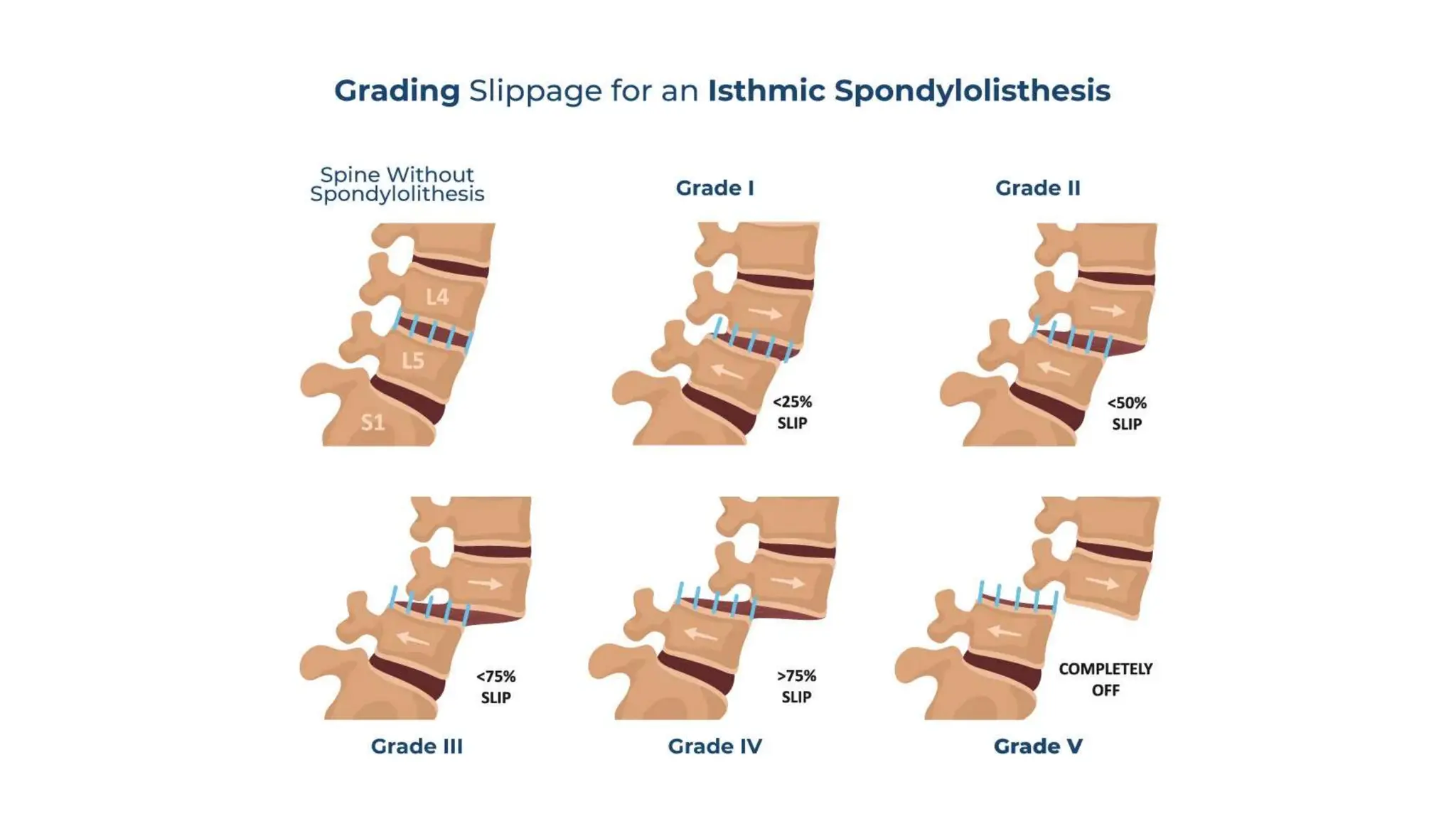spondiloliztezis ve spondilolizis-2.pptx