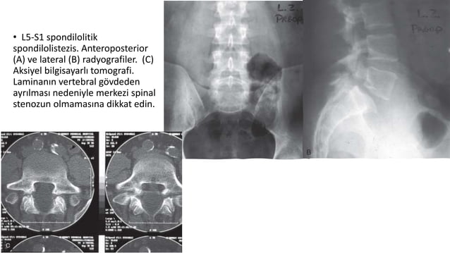 spondiloliztezis ve spondilolizis-2.pptx