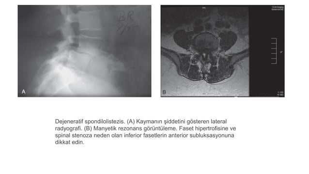 spondiloliztezis ve spondilolizis-2.pptx