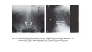 spondiloliztezis ve spondilolizis-2.pptx