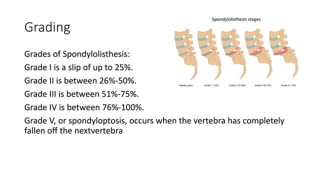 spondiolisthesis is one of spine injury. | PPT