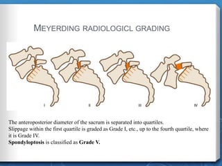 Spondylolisthesis review | PPTX