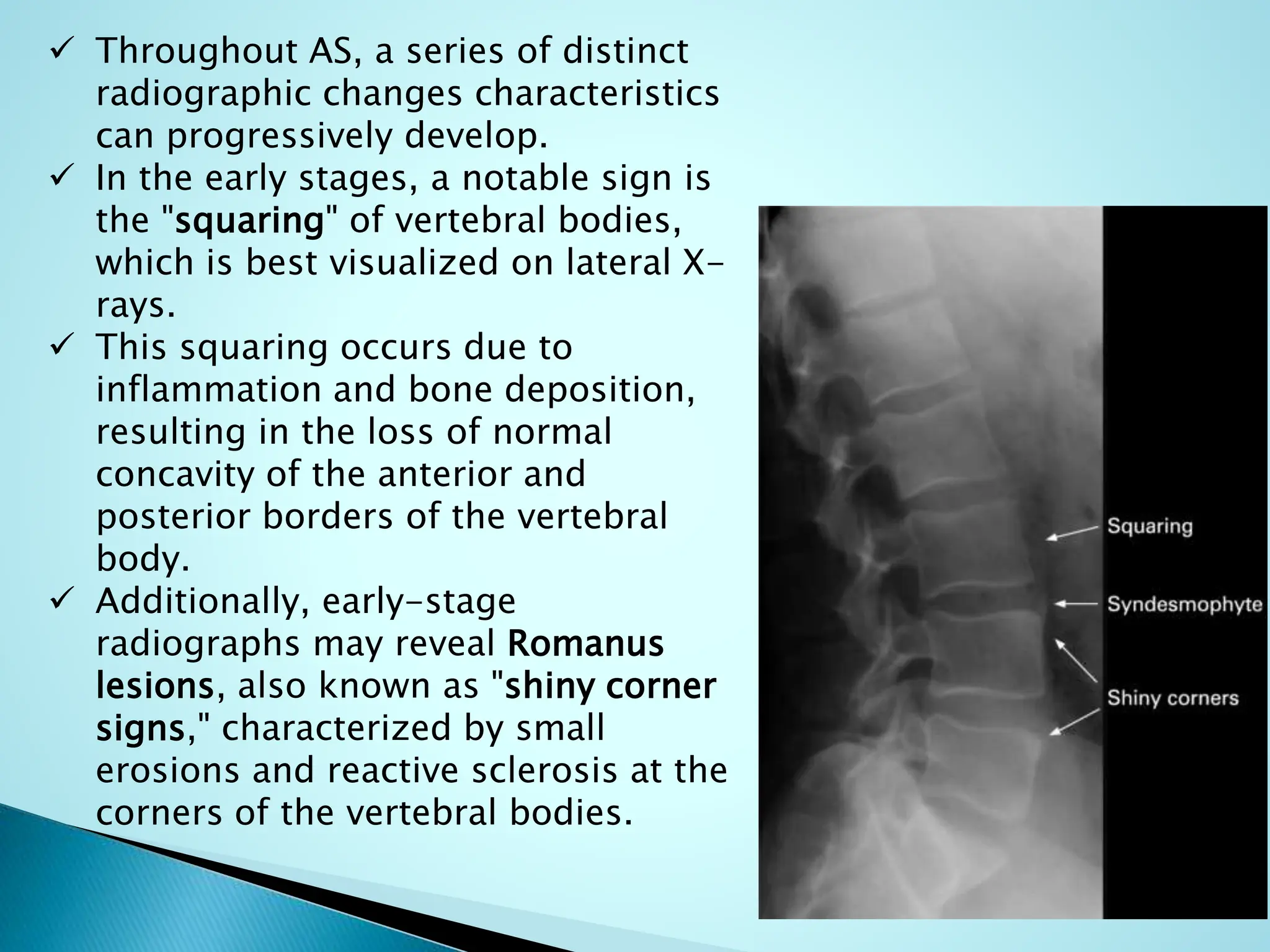 Ankylosing Spondylitis PPT pharmacotherapeutics II | PPTX